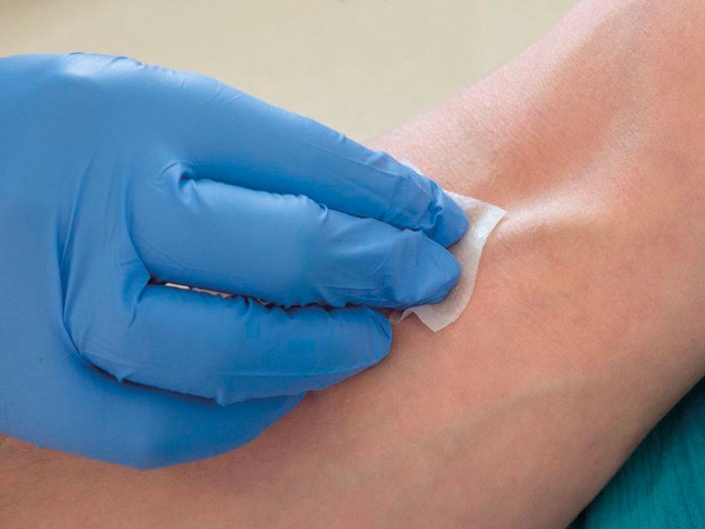 Freshly Placed Peripheral Catheter Collections | How It Works & Steps ...